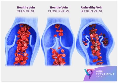 Vein Centers of California | Laser Ablation